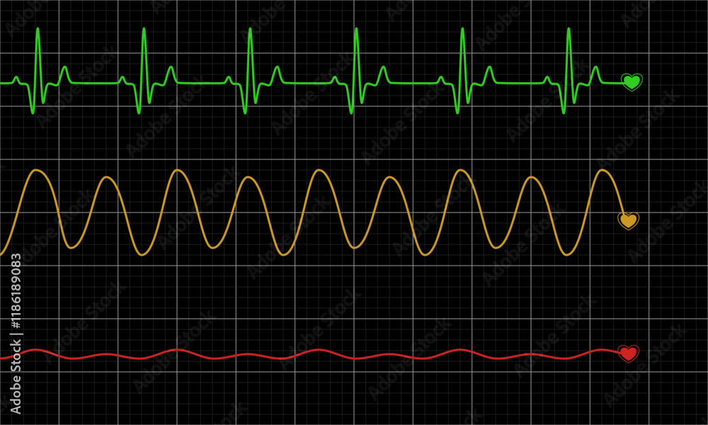 Three types of normal and abnormal heart rhythm. Vector Medical ...