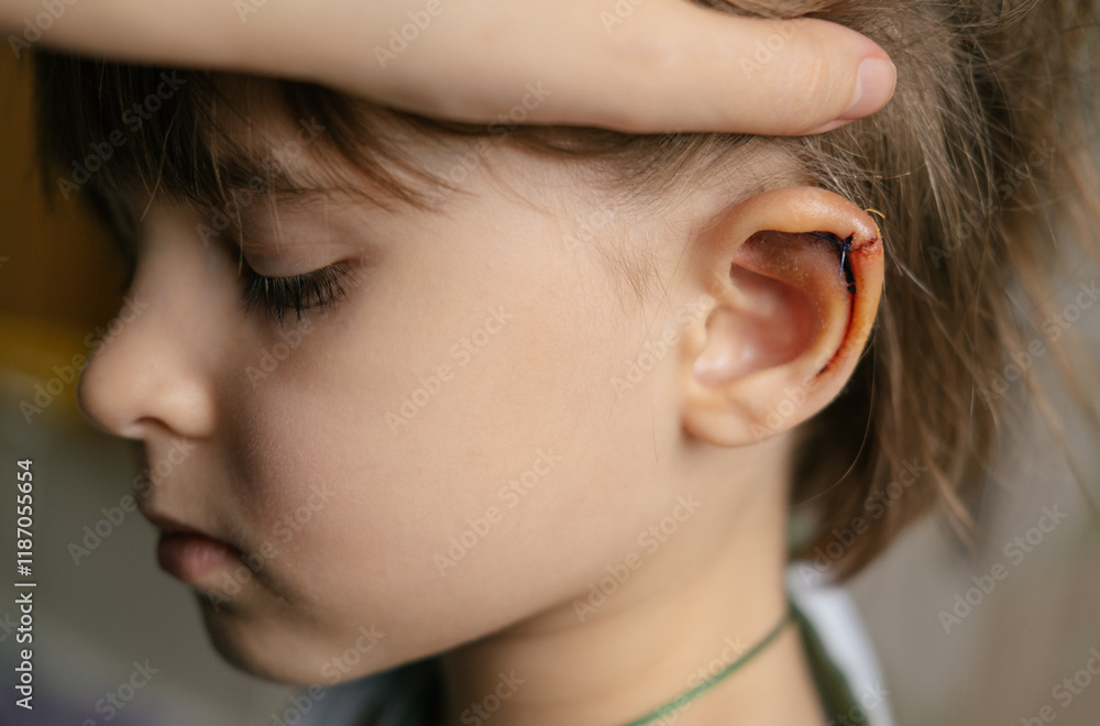 Stitches on the kid torn ear, dissection, suturing, bruise on the ear ...