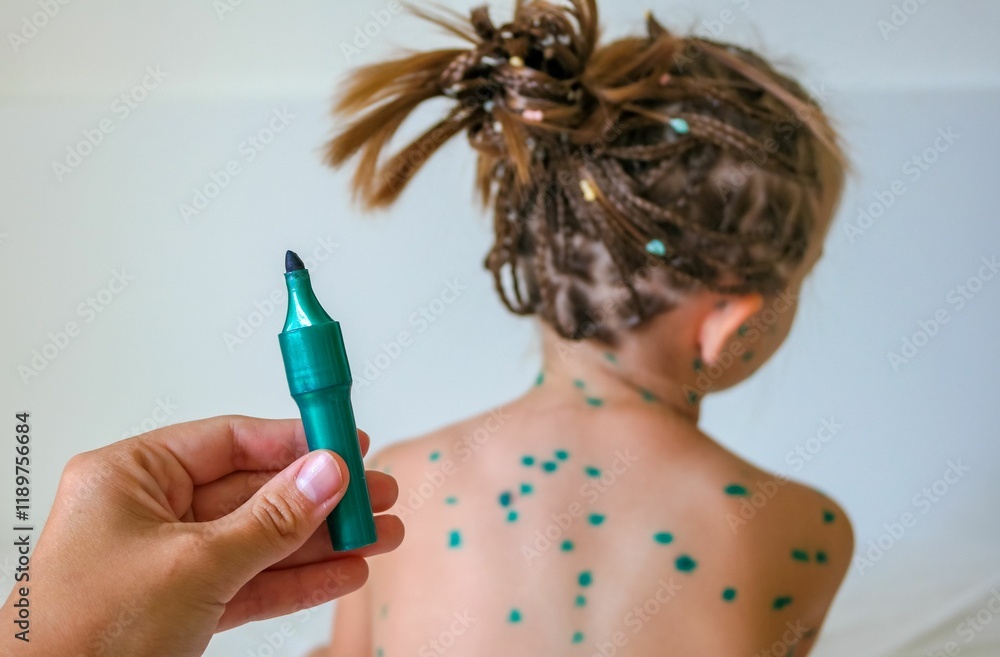 Smearing chickenpox ulcers on the back of a little girl with brilliant ...