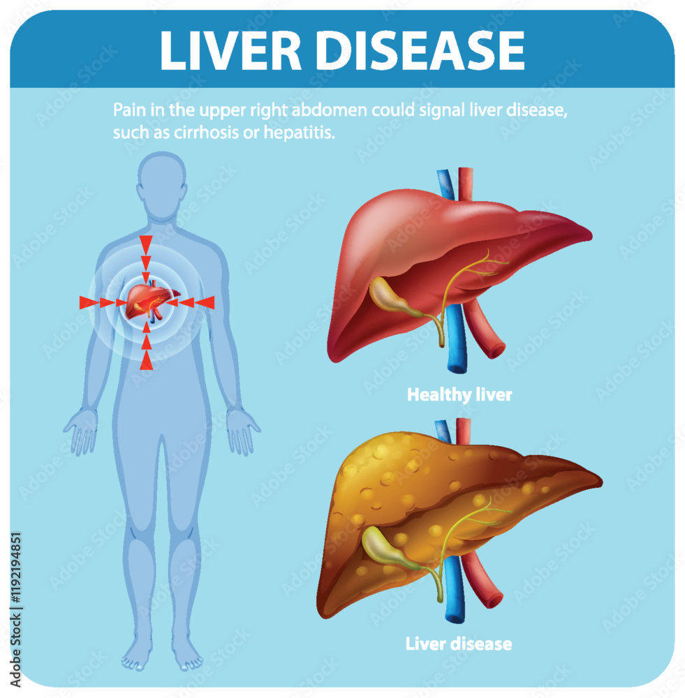 Understanding Liver Disease and Its Symptoms Stock Vector | Adobe Stock
