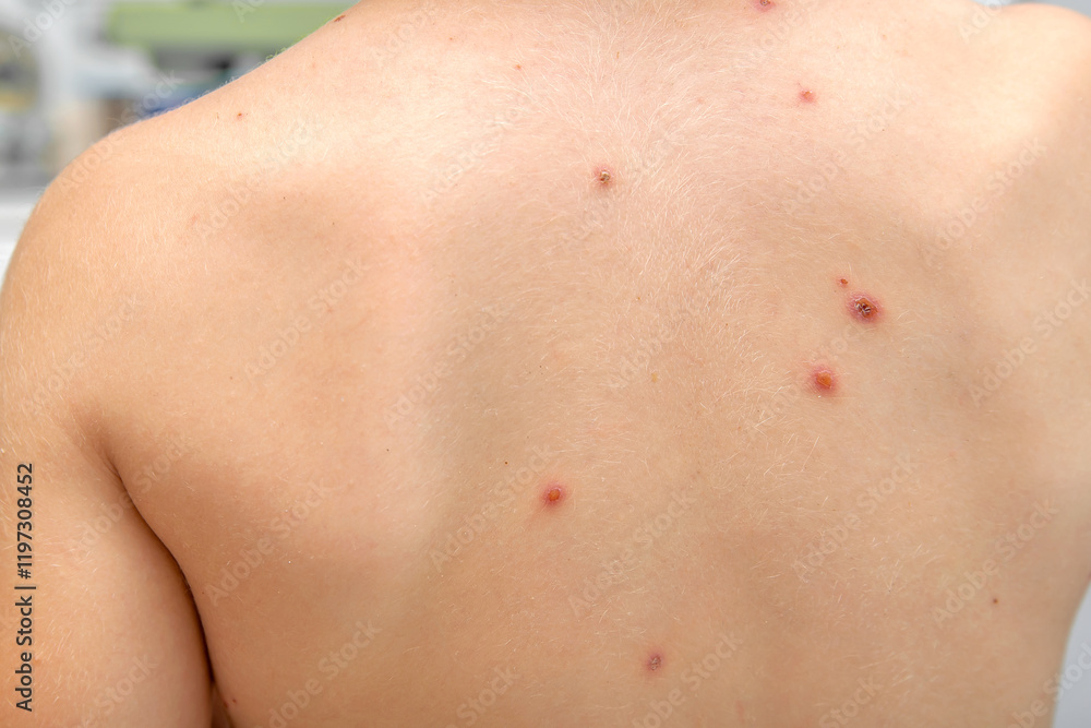 Rash on little boy child body,Chickenpox,Varicella contagion virus ...