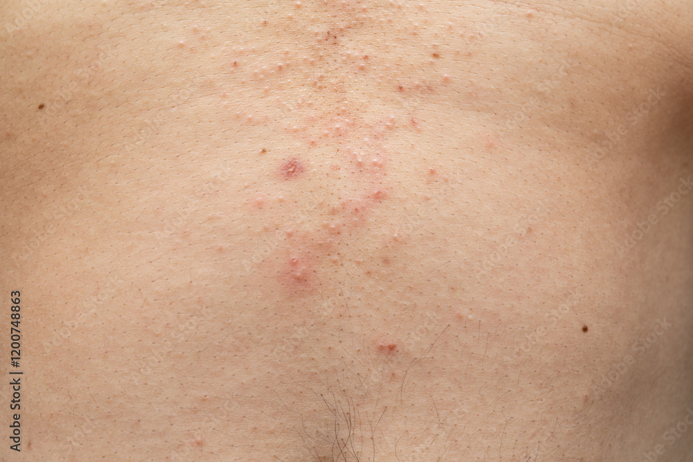 Atopic eczema on the stomach. Allergy, allergic reaction from atopic ...