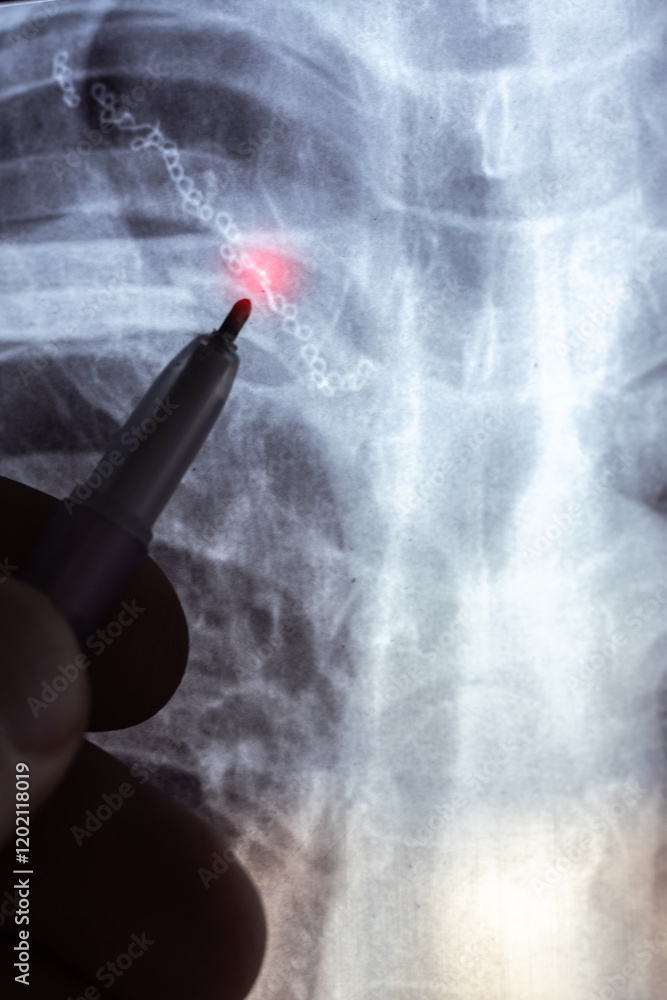 Doctor learning vertical X-ray medical image of a sutured human lung ...