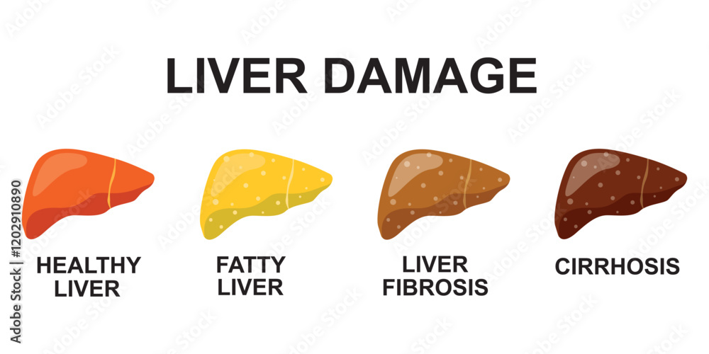 Stages of nonalcoholic liver damage. Healthy, fatty, fibrosis ...