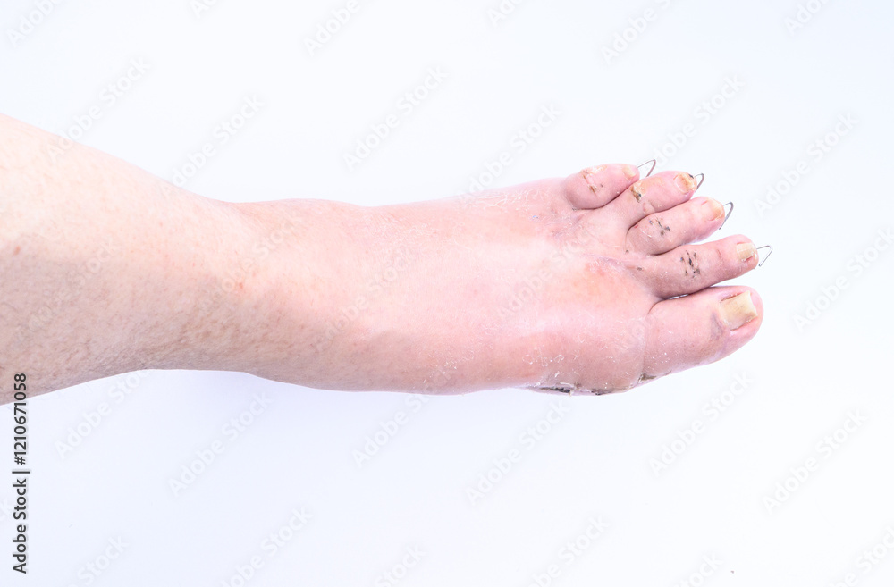 Doc reviewing foot surgery, capsulotomy, scarf type osteotomy, Hallux ...