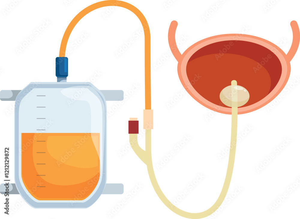 Medical illustration showing urinary catheter draining urine into ...