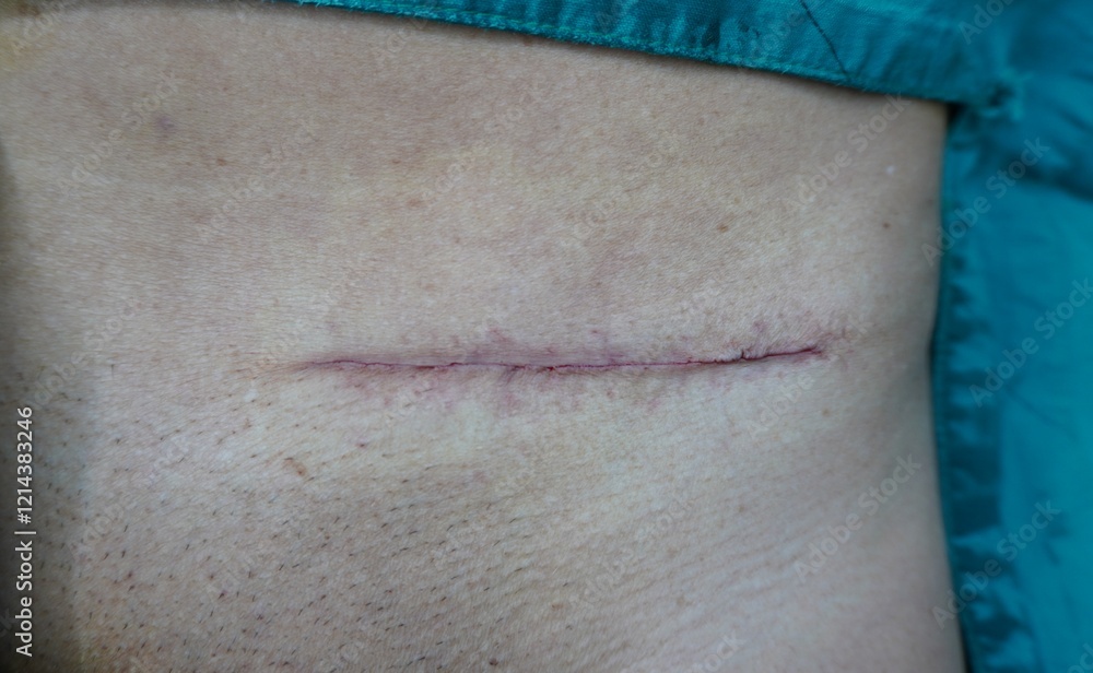Surgical wound was closed by subcuticular suture technique. End of ...