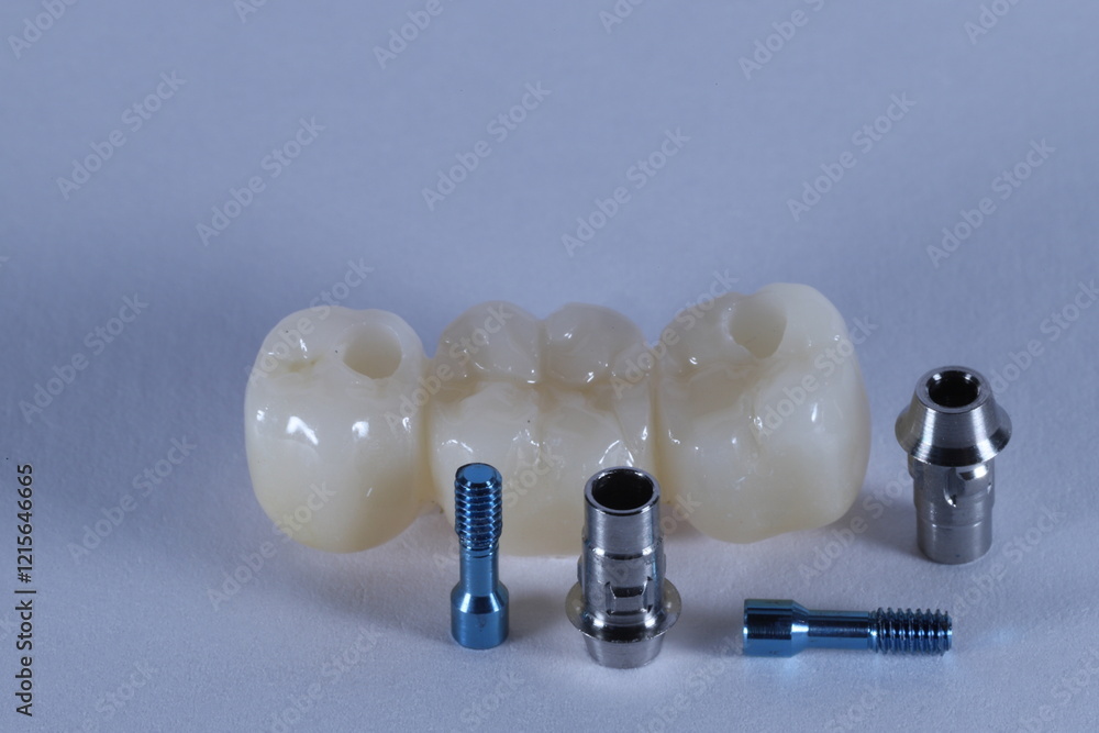 Dental implant surgery and dental implant supported bridge prosthesis ...
