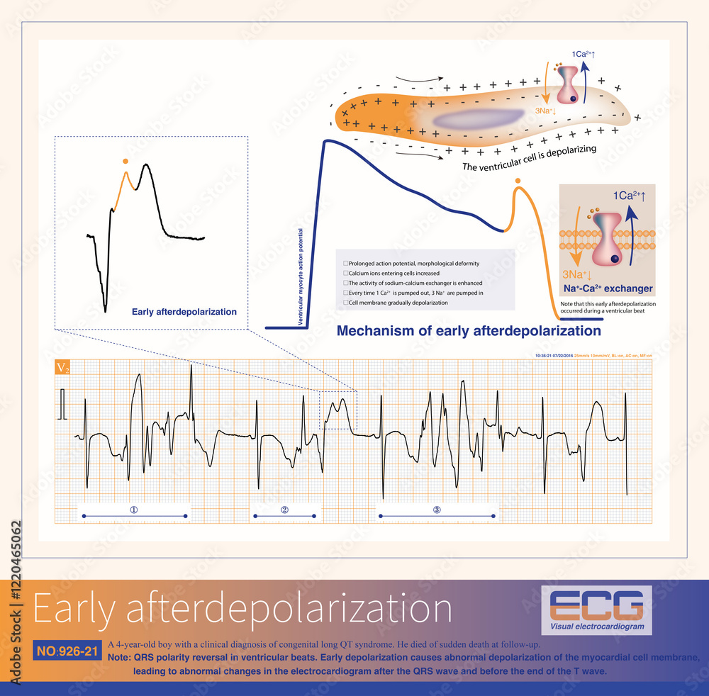 Early afterdepolarization is an arrhythmogenic mechanism that triggers ...
