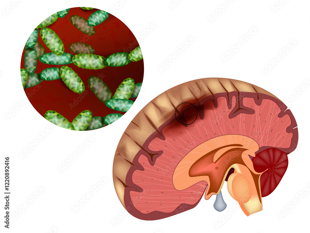 Bacterial Meningitis Illustration. Brain Infection and Bacteria Medical ...