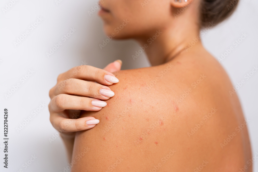 Red rash on the female back. Young woman touching her shoulder showing ...