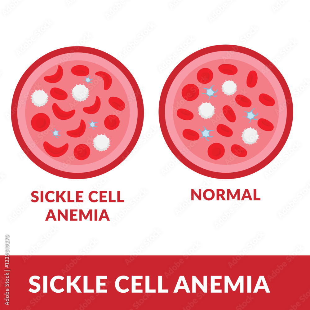 Sickle cell disease. The difference of Normal red blood cell and sickle ...