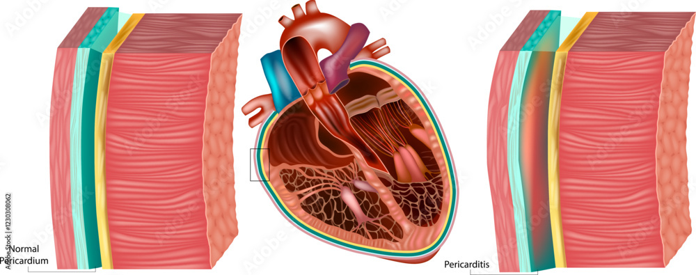 Vector de Stock Pericarditis and Normal Pericardium Medical ...