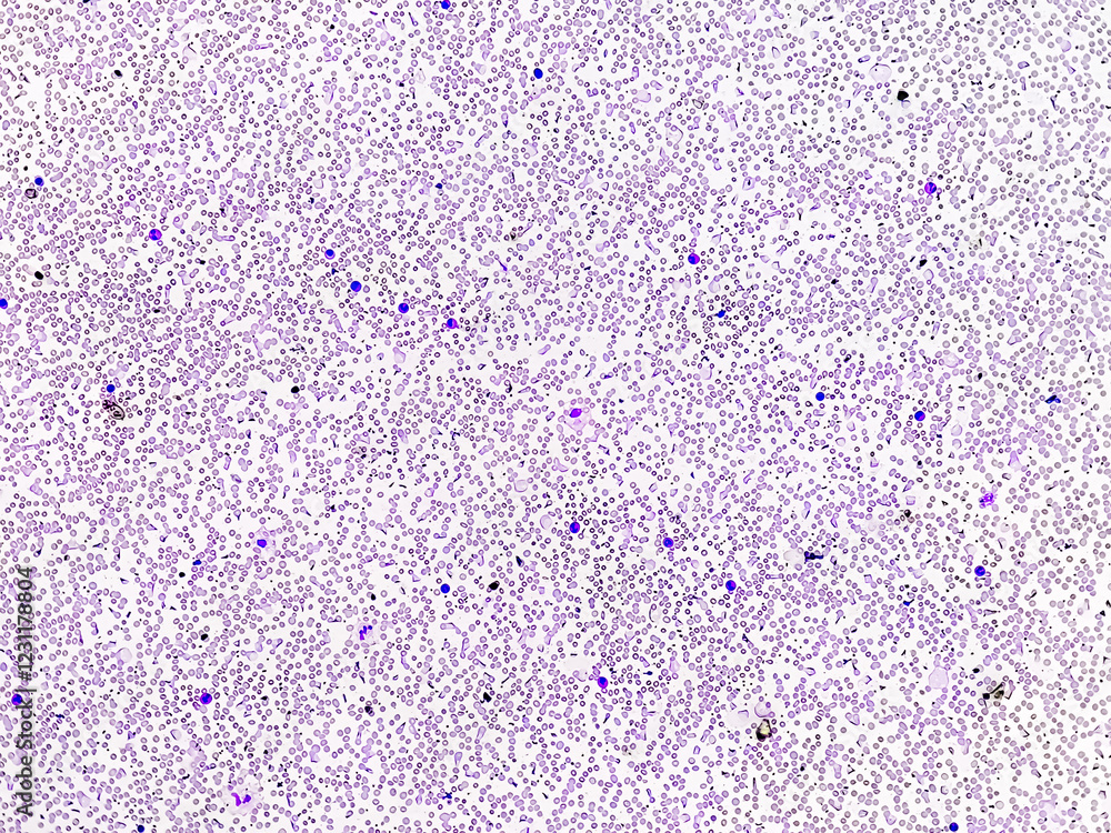 Peripheral blood smea, the red blood cells (RBCs) show anisocytosis ...