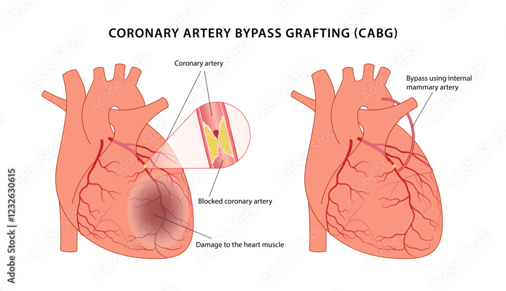 Coronary artery bypass grafting (CABG). Medical illustration of bypass surgery of a diseased ...