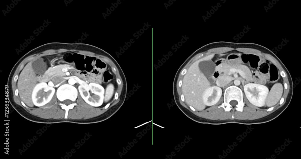 Contrast-enhanced CT whole abdomen study revealing normal anatomical ...