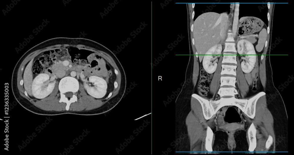 Contrast-enhanced CT whole abdomen study revealing normal anatomical ...