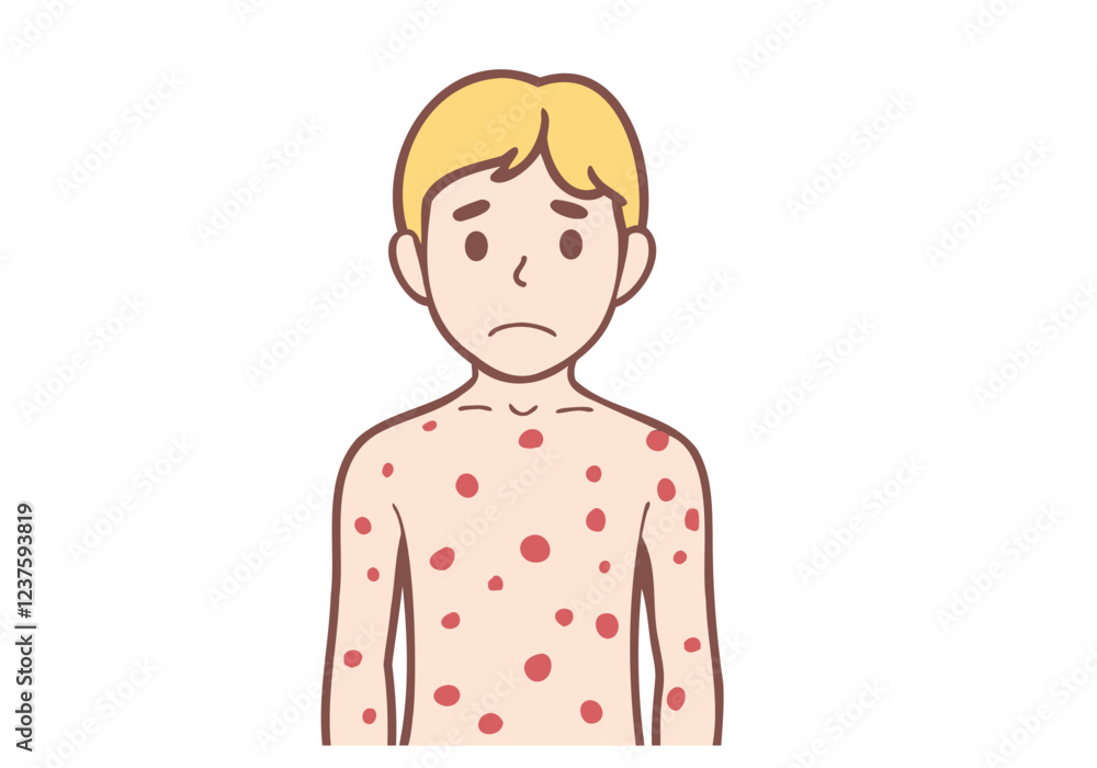Child with Measles Rash: Illustration of a young boy with a visible ...