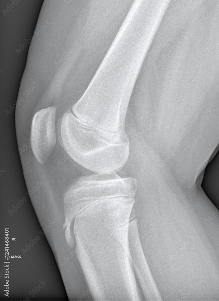 X-ray image reveals Osgood-Schlatter disease affecting knees. Captures ...