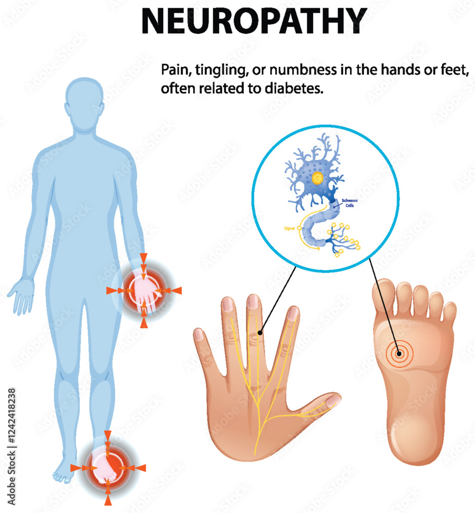 Understanding Neuropathy and Its Symptoms Stock Vector | Adobe Stock