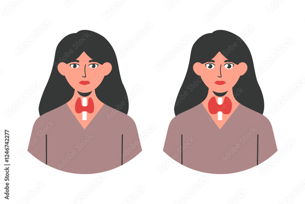Graves Disease Illustration Showing A Woman With Bulging Eyes And Enlarged Thyroid Compared To