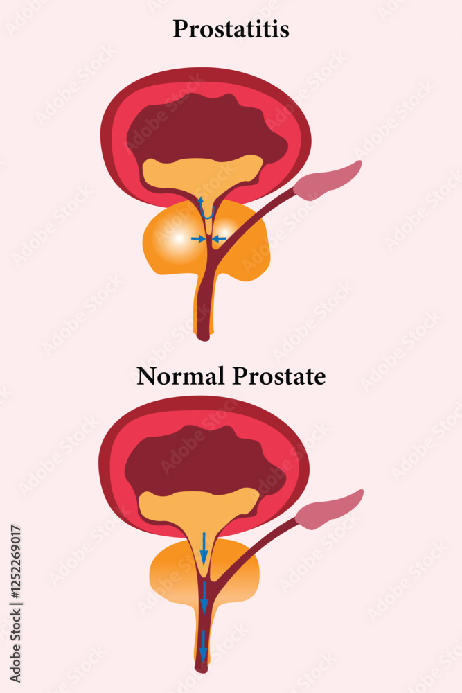 Medical illustration comparing prostatitis and normal prostate with ...