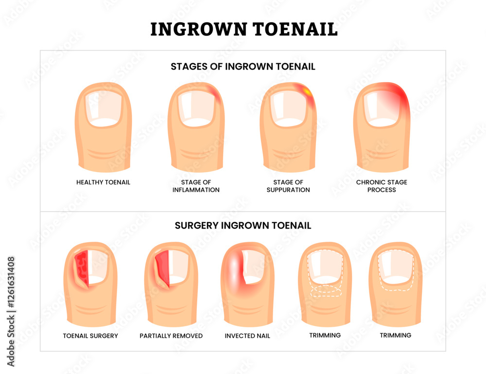 Set different types of ingrown toenail collection with ingrown toenail ...