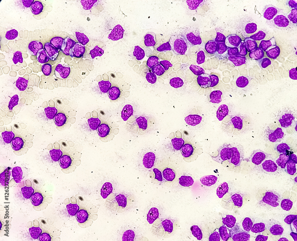 Acute myeloid leukemia (AML) is a type of blood cancer. Microscopic examination of blasts or ...