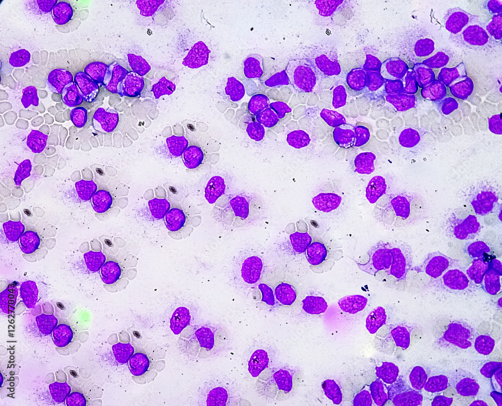 Acute myeloid leukemia (AML) is a type of blood cancer. Microscopic ...