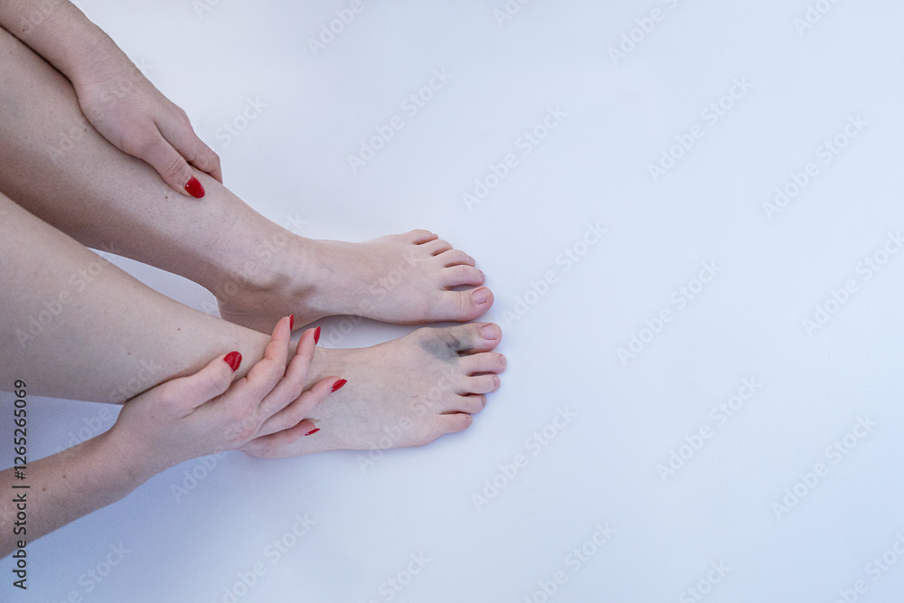 woman sprained her leg. trauma in everyday life. female leg with bruise ...