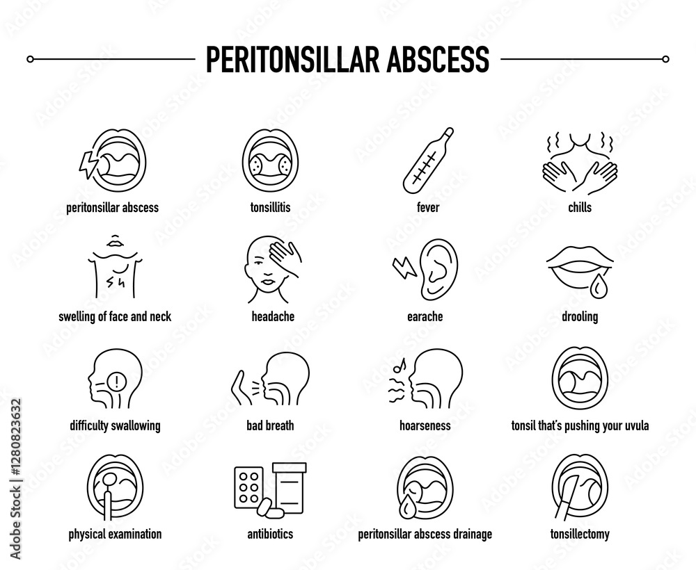 Peritonsillar Abscess symptoms, diagnostic and treatment vector icon ...