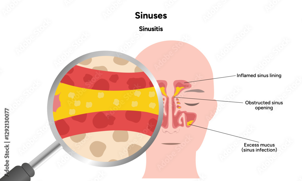 Sinuses anatomy sinusitis. Nose nasal anatomy. Inflammation Nasal ...
