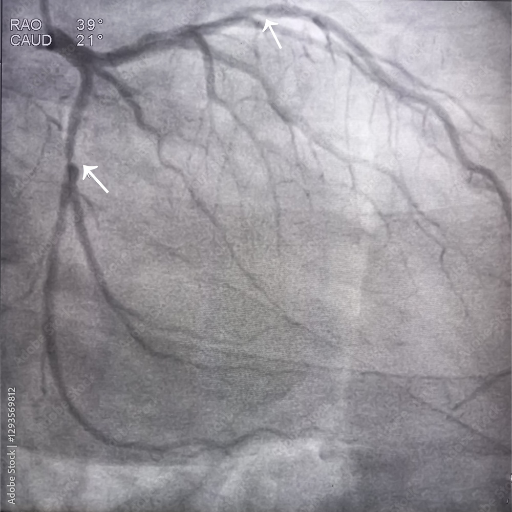 Coronary angiogram of left coronary artery during cardiac ...