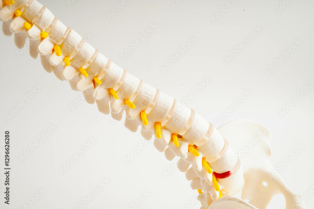 Spinal nerve and bone, Lumbar spine displaced herniated disc fragment ...