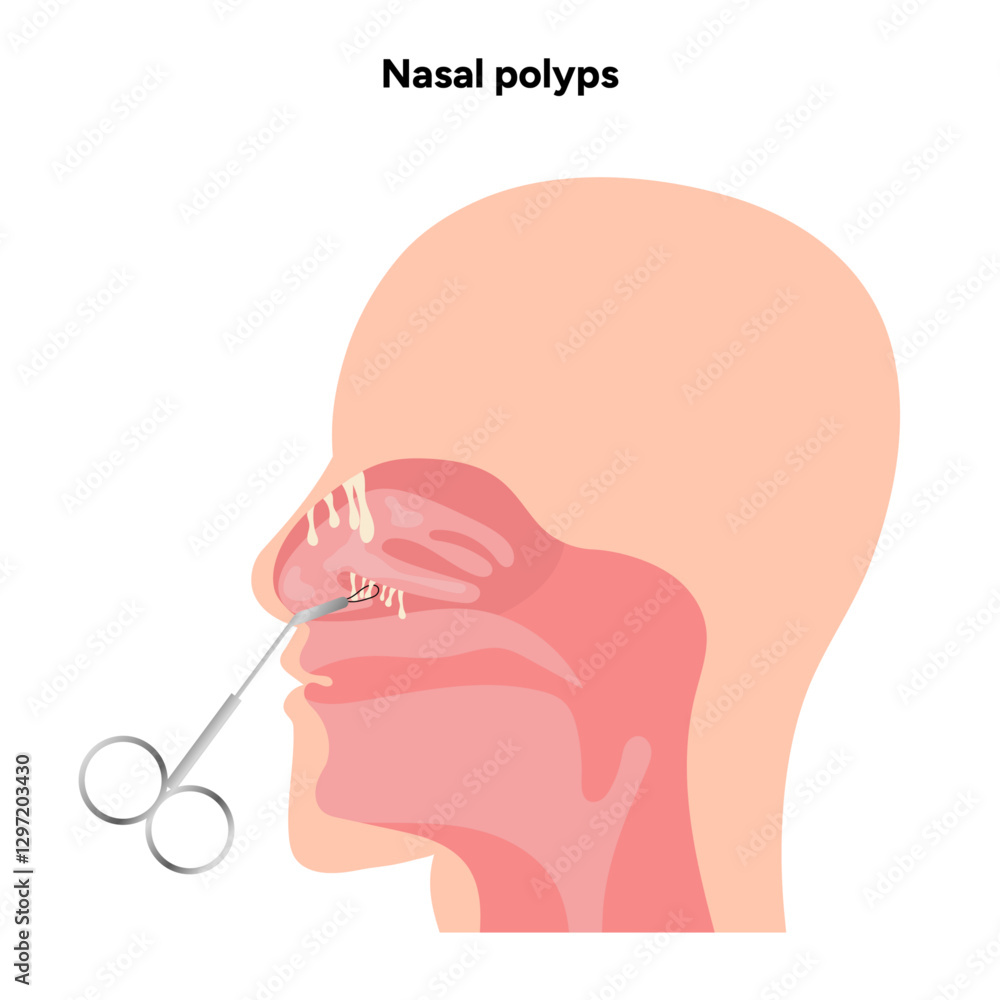 Nasal polyps, nose disease. Diagnostic and treatment. Medical diagram ...