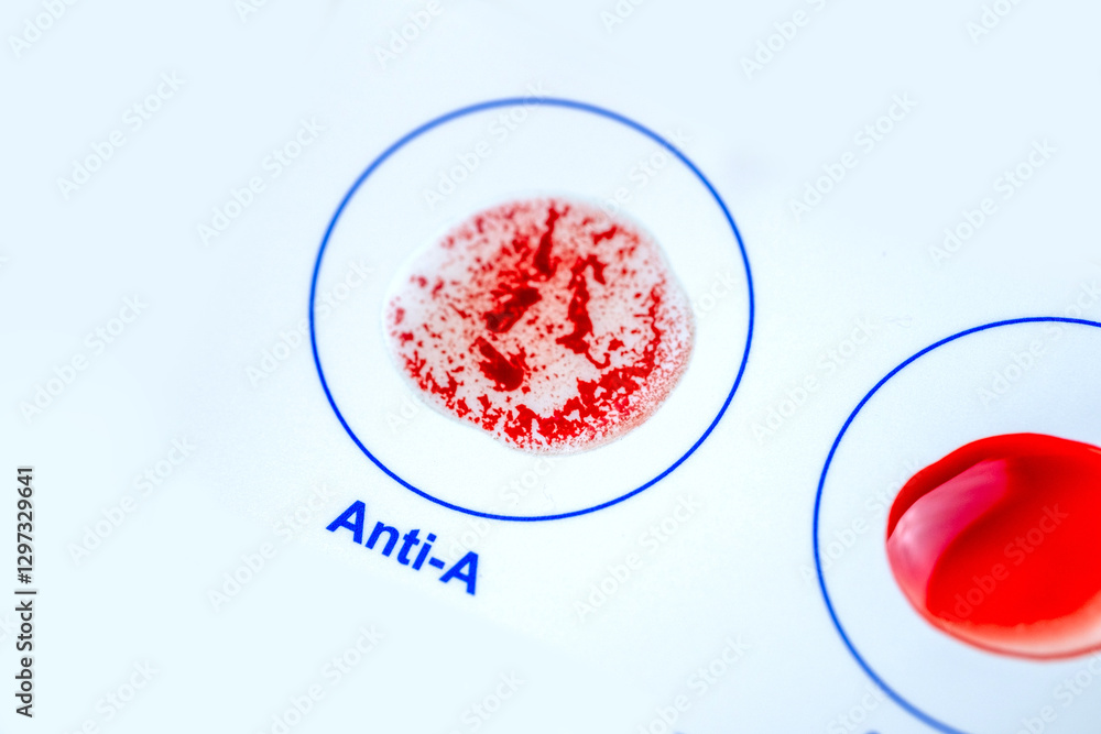 Blood typing test card with Anti-A result, diagnostics and health ...