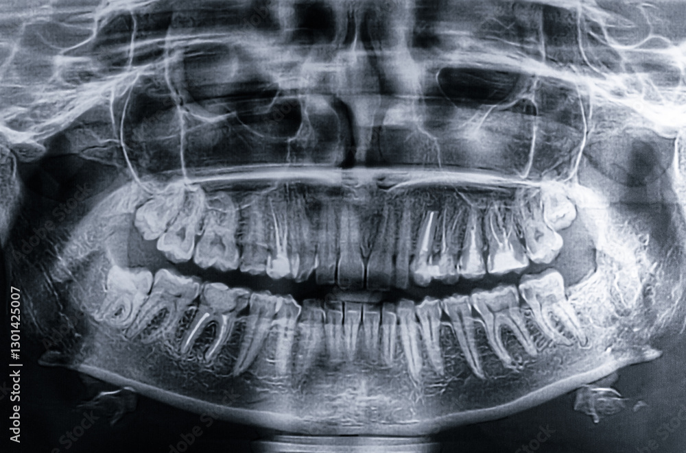 Female jaw and teeth through x-ray. Panoramic x-ray of human teeth ...