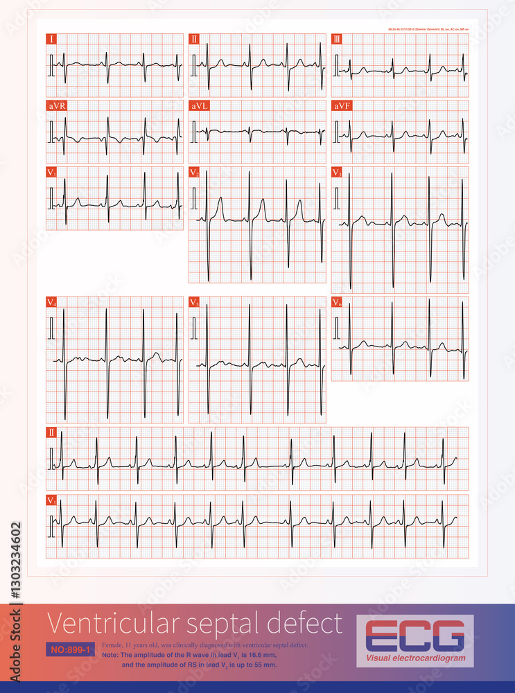 In Ventricular Septal Defects Left Ventricular Hypertrophy 6877