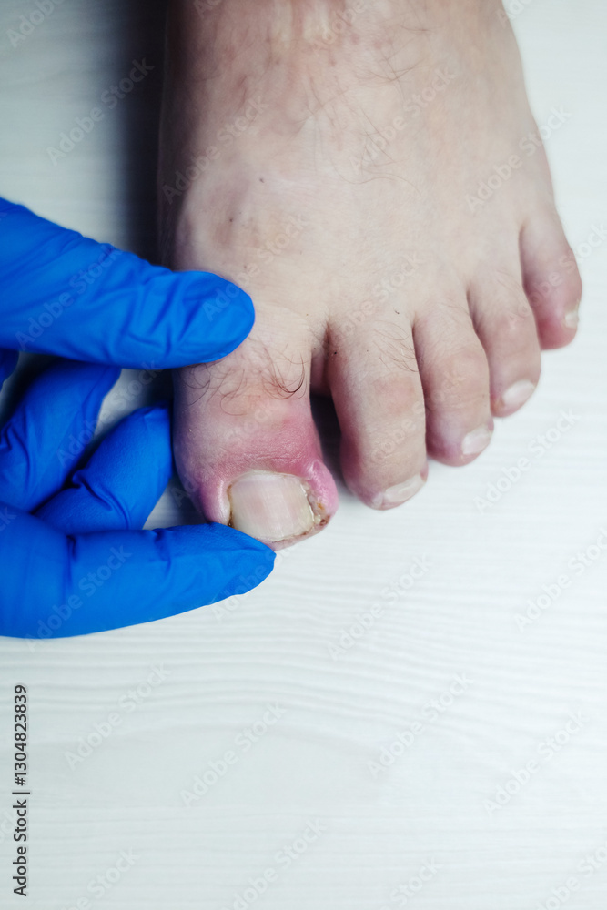 Finger infection. Paronychia, onychomycosis, nail psoriasis ...