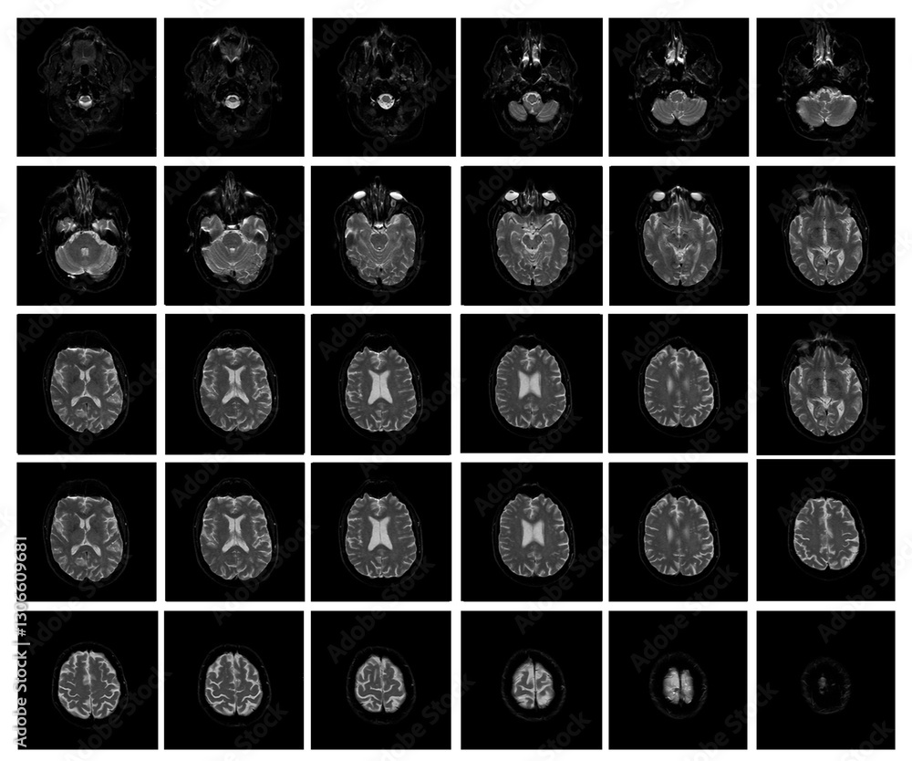 1 of the 12 Magnetic Resonance images series of a 67yo man. MRI brain and brainstem: axial ...