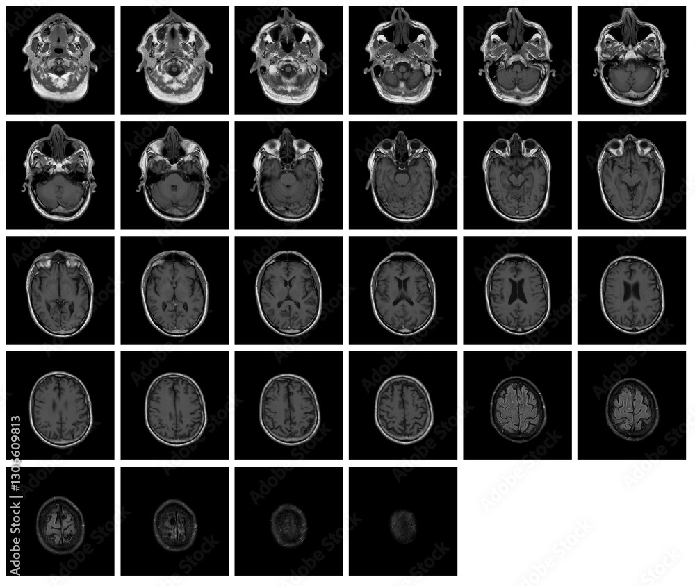 1 of the 12 Magnetic Resonance images series of a 67yo man. MRI brain and brainstem: axial ...