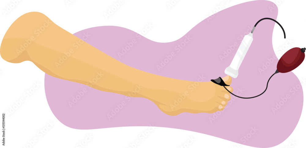 Vektor The Toe Brachial Pressure Index (TBPI) is a non-invasive ...