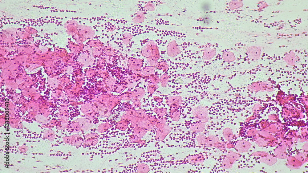 Human cervical squamous epithelial cells, pap smear, NILM (class II non ...