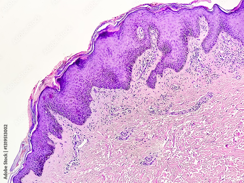 Photomicrograph showing keratosis of the Skin, hematoxylin eosin ...