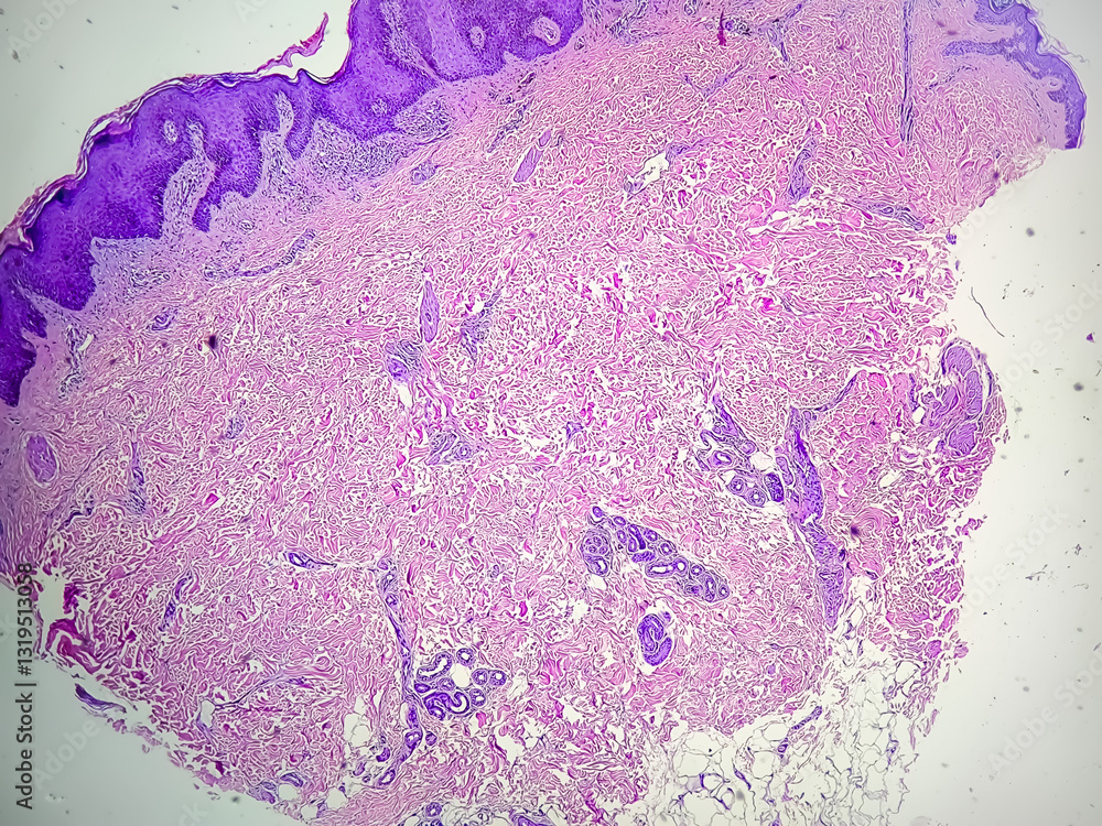 Photomicrograph showing keratosis of the Skin, hematoxylin eosin ...