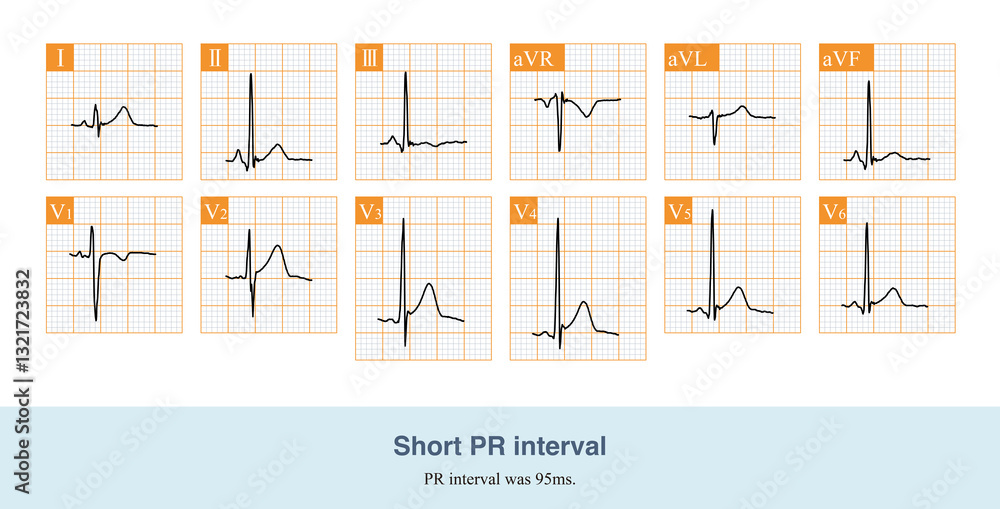 Male, 38 years old. There is no history of tachycardia in clinical ...