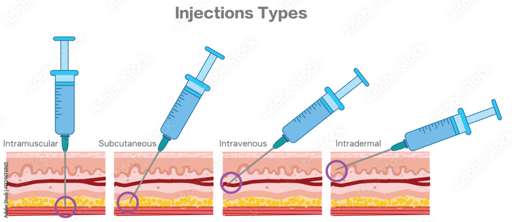 Injection angle types. Intramuscular, subcutaneous intradermal, intravenous injection. Guide ...