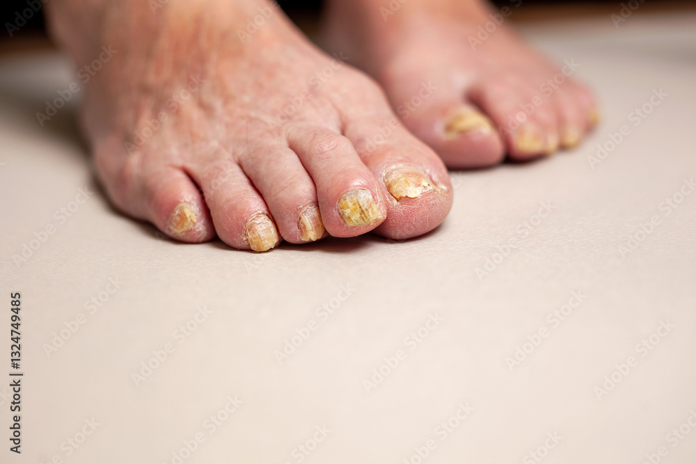 Onycholysis of nails, Paramedicine, medical pedicure, aging problems ...