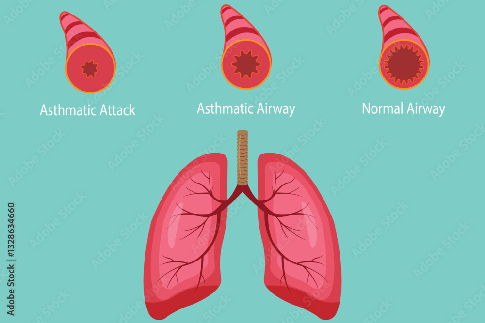 Lung diagram depicting normal and asthmatic airway conditions Stock ...