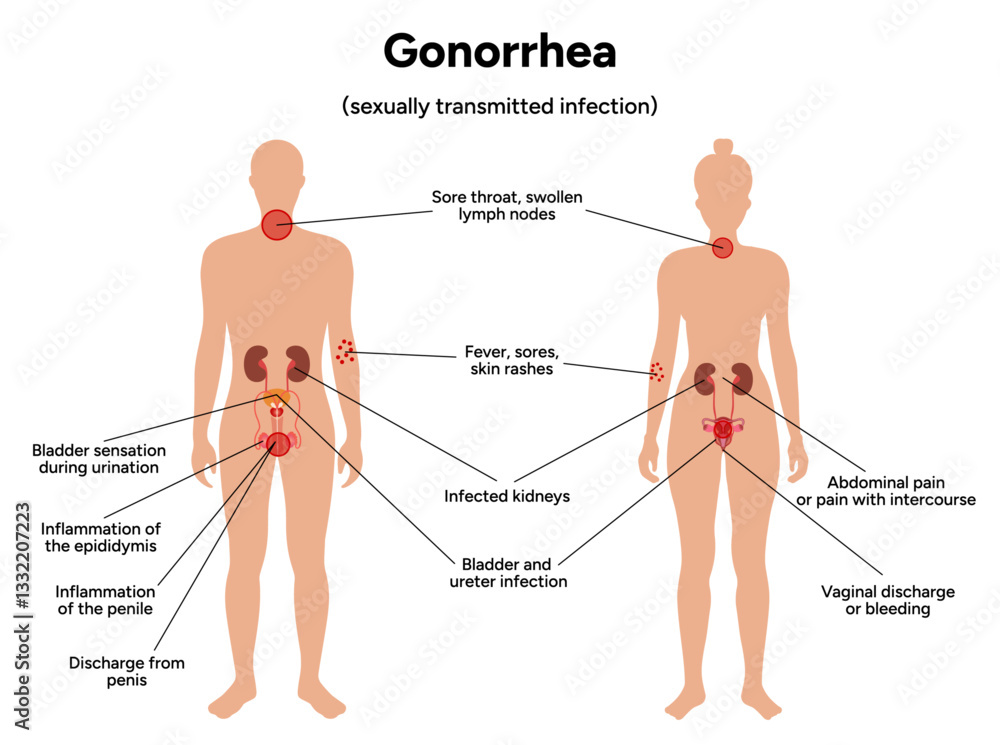 Gonorrhea Human Reproductive System Transmitted Infection Virus 5811